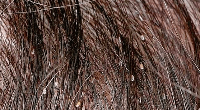 LET OP: gemuteerde super-hoofdluis in Nederland, controleer je kinderen ...